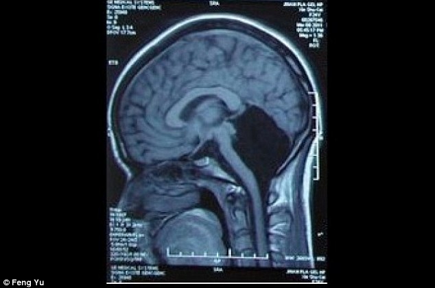 24-year old woman discovers part of her brain is missing - Canada ...