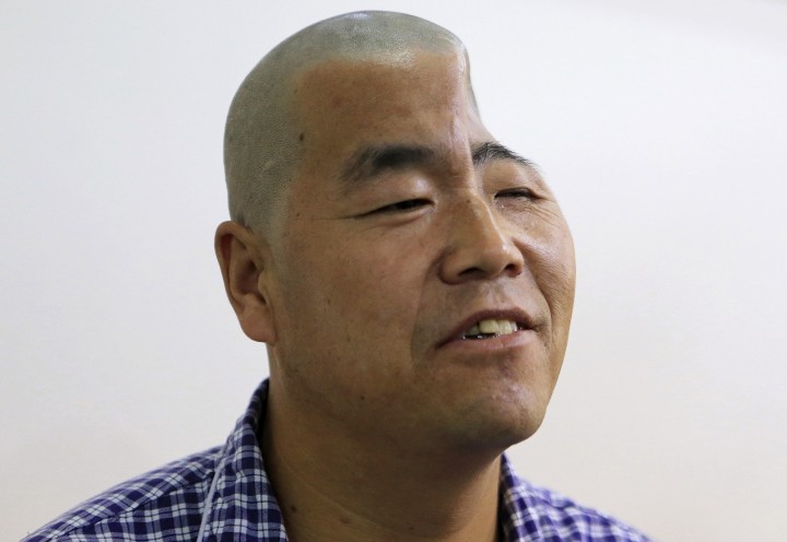 Man gets titanium skull (Video) - Canada Journal - News of the World