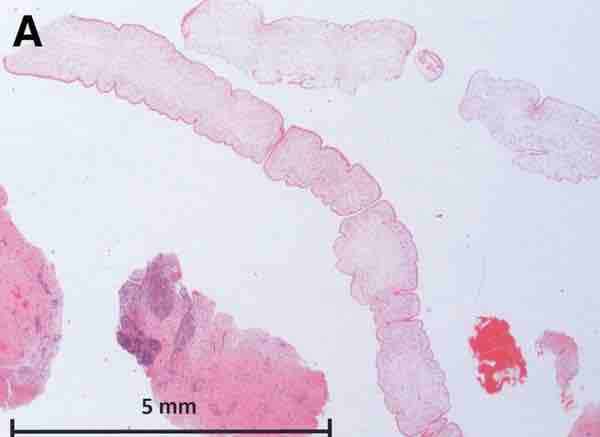 Tapeworm in brain : Worm Lives in Man's Head for Four Years (Video ...