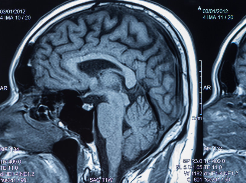 After 15 Years in a Vegetative State, an implant makes a man cry again ...